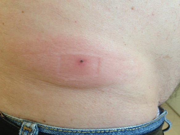 Morso di Zecca | Andrea Bedini – Malattie Infettive & Tropicali