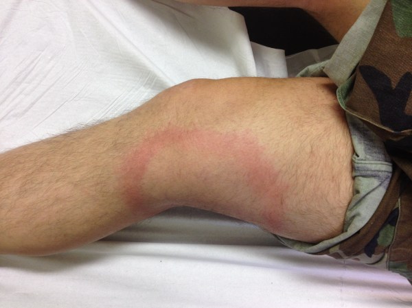 Morso di Zecca | Andrea Bedini – Malattie Infettive & Tropicali